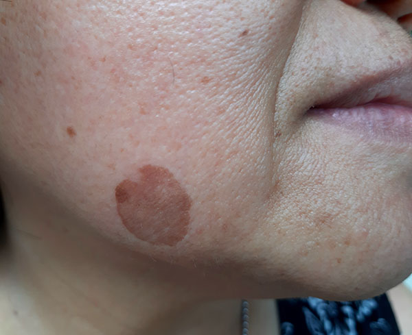 Asian,Women,Having,A,Skin,Problem,With,Melasma,And,Wrinkles ...