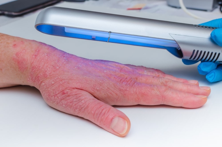 Phototherapy in Winter Park and Orlando – Dermatology Clinic & Cosmetic ...